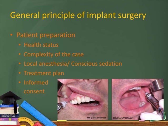 Standard Implant surgical procedure | PPT