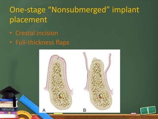 Standard Implant surgical procedure | PPT