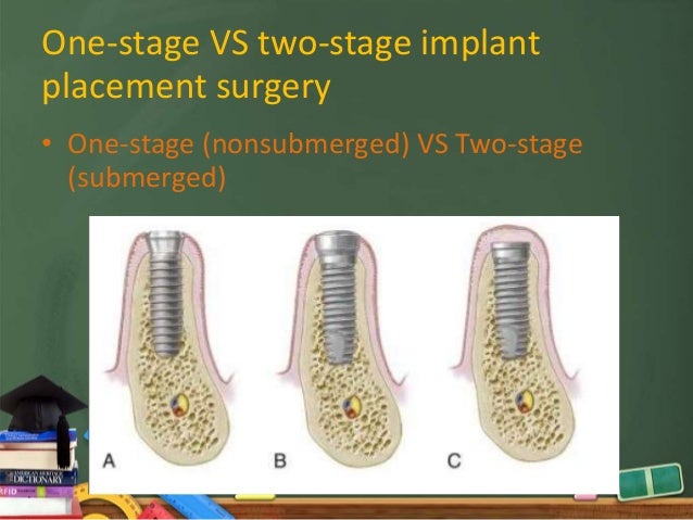 Standard Implant surgical procedure