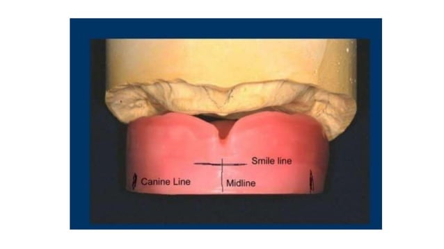 Teeth selection for complete denture | PDF