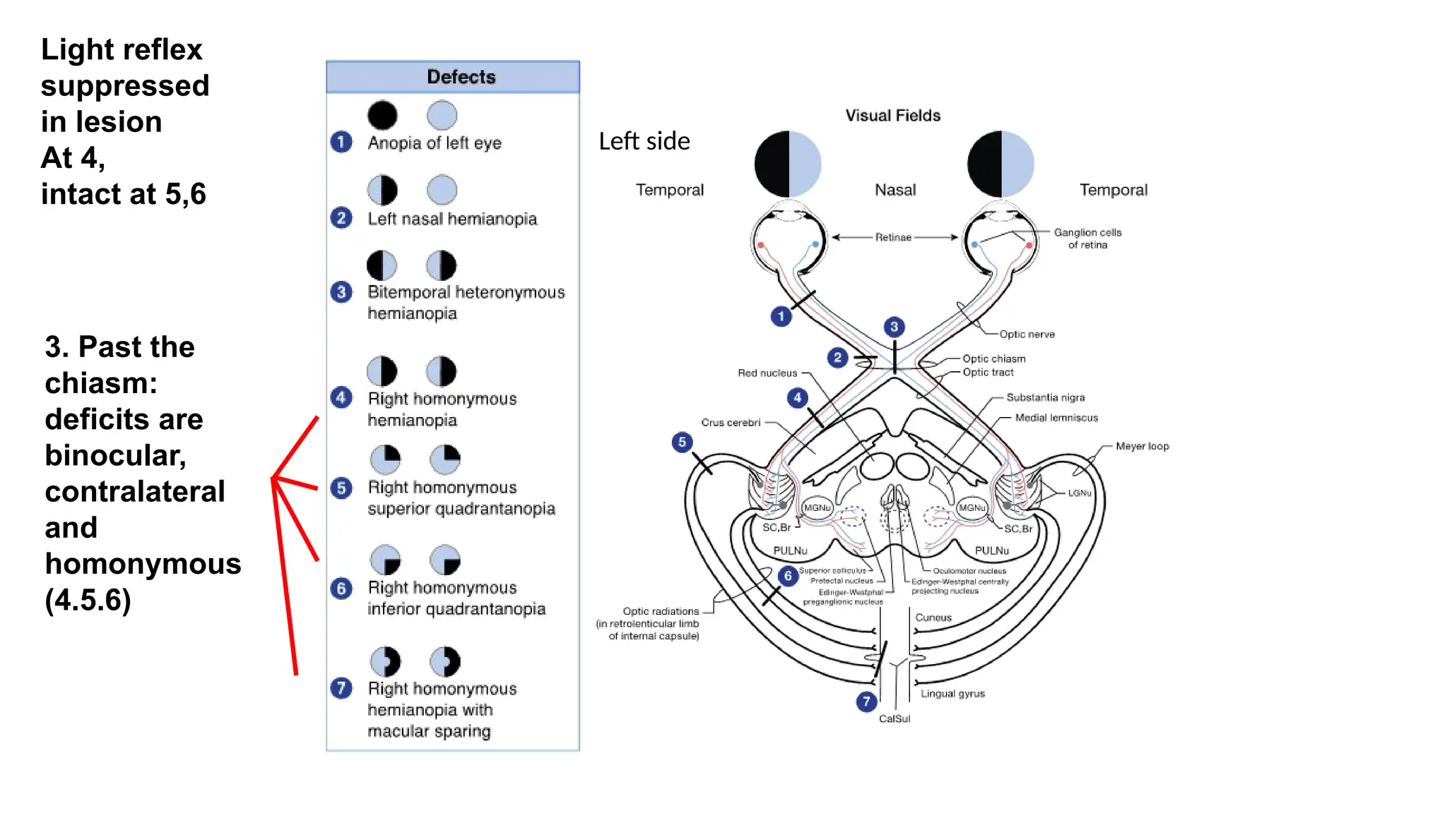 Visual Pathways: Ophthalmology textbook AK khurana comprehensive ...