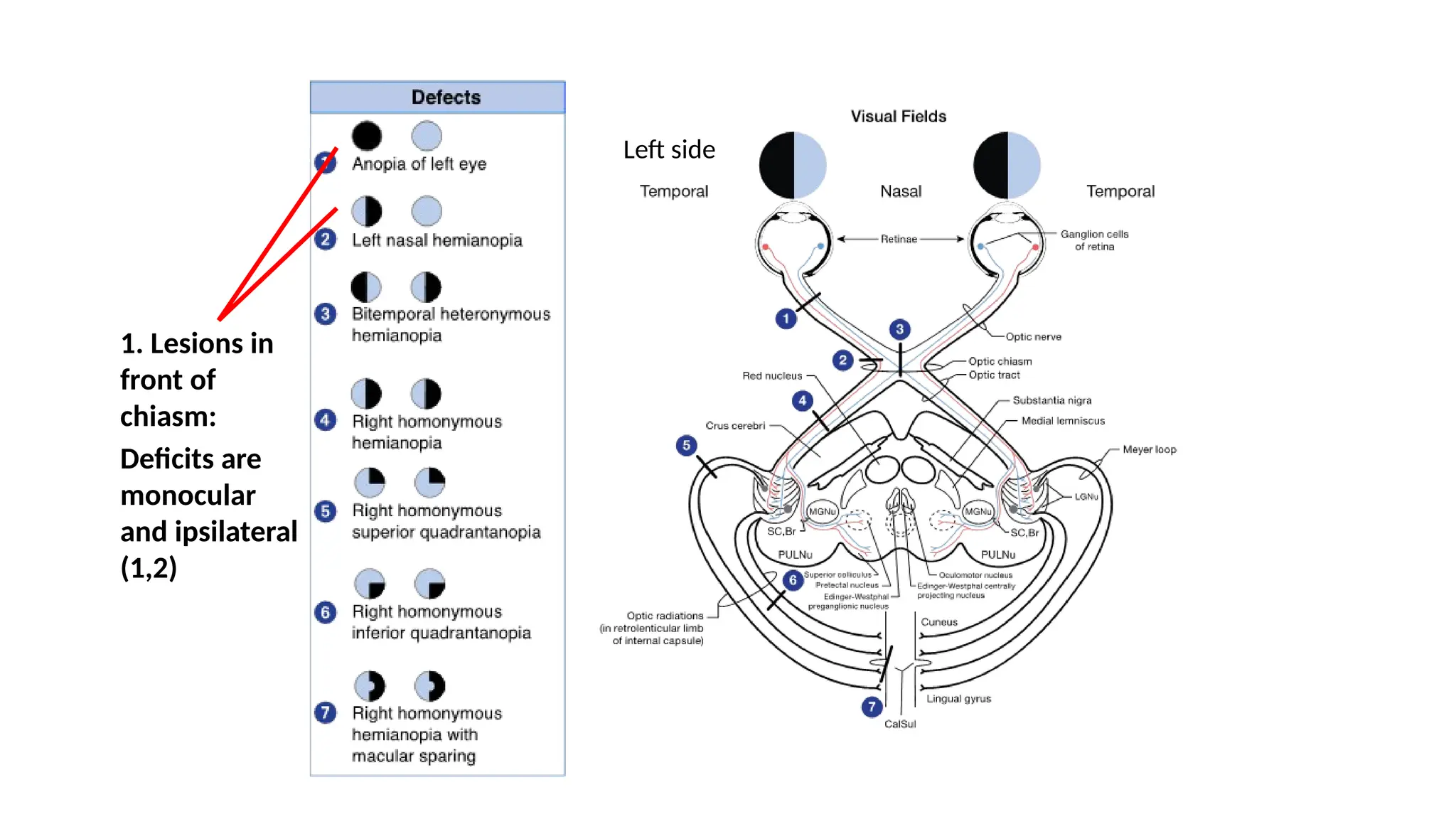 Visual Pathways: Ophthalmology textbook AK khurana comprehensive ...