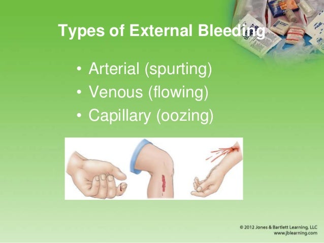 Name Some Types Of Bleeding
