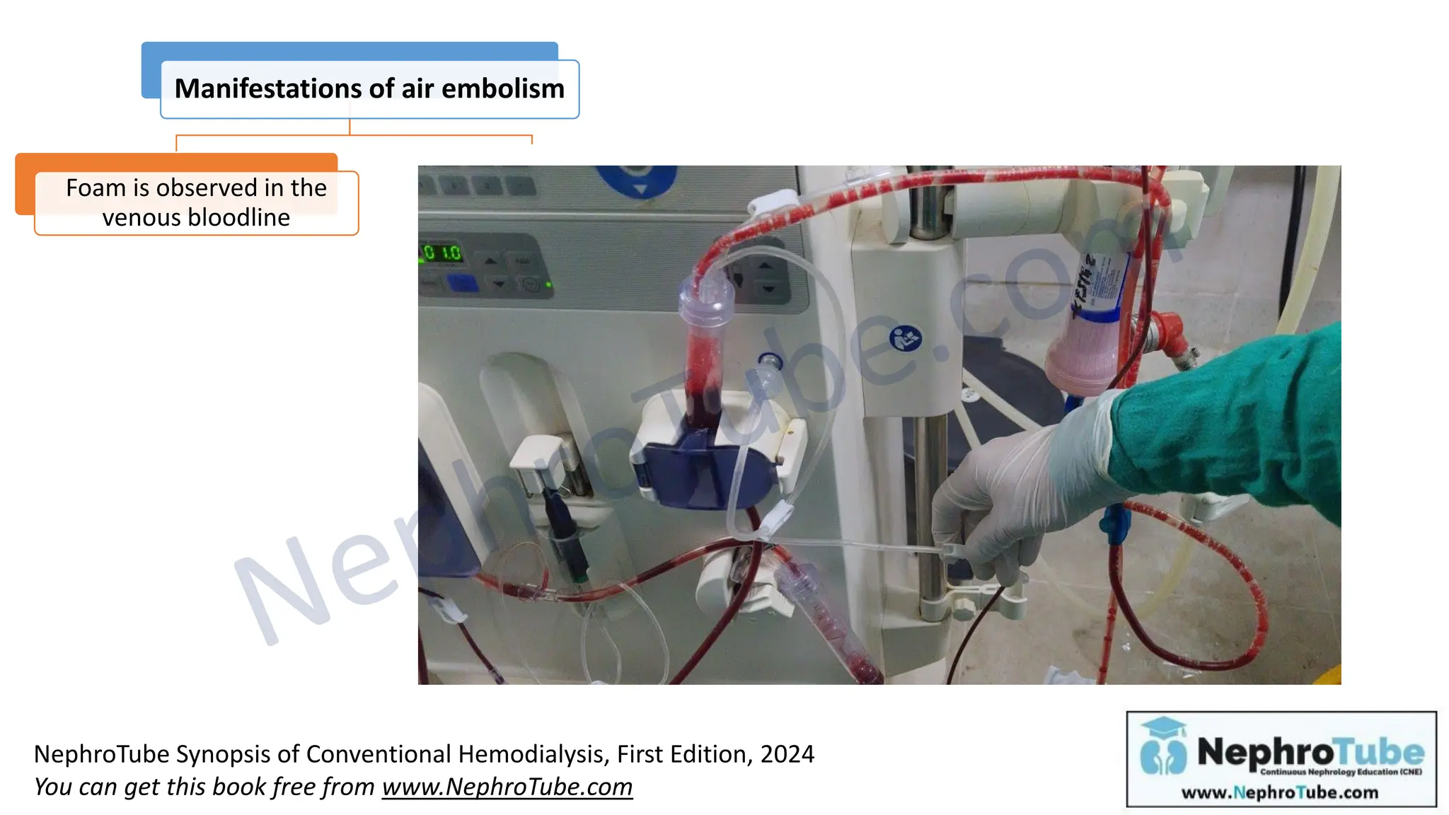 Hemodialysis: Chapter 8, Complications During Hemodialysis, Part 2 - Dr ...