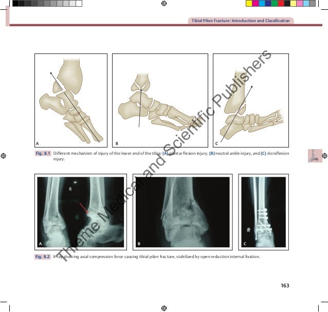Ao Ankle Fracture Classification Ao Ankle Fracture Classification