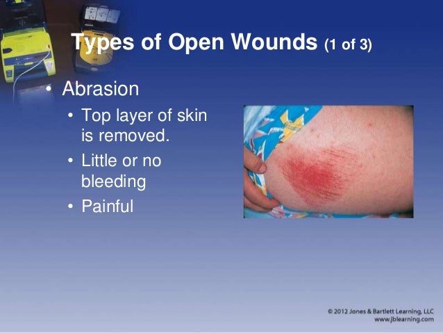 Open Wound Definition : Wound Care: How to Care for an Open Wound or ...