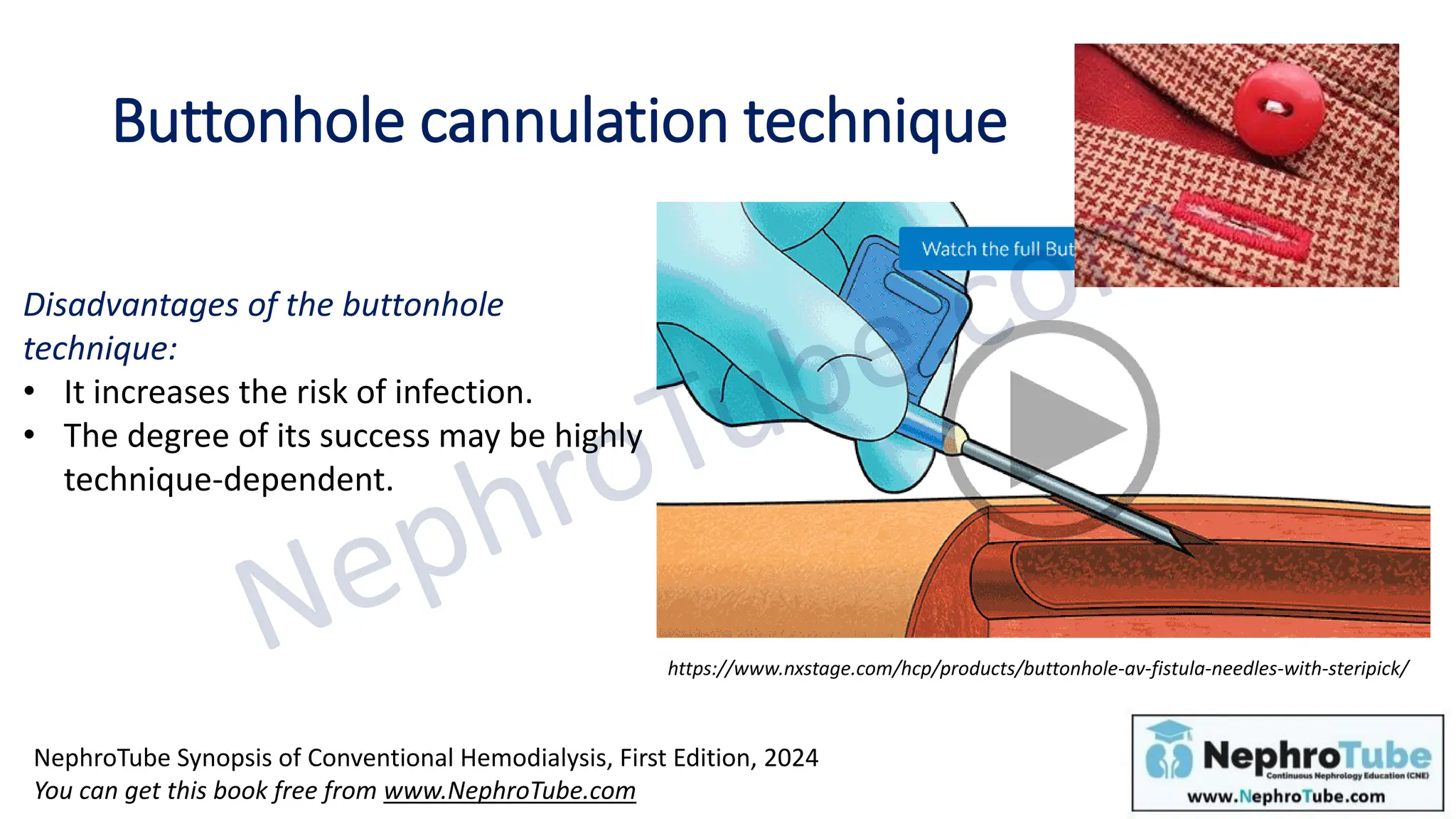 Av Fistula Needle Insertion