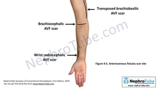 Hemodialysis: Chapter 9, Arteriovenous Fistula and Graft: Basics ...