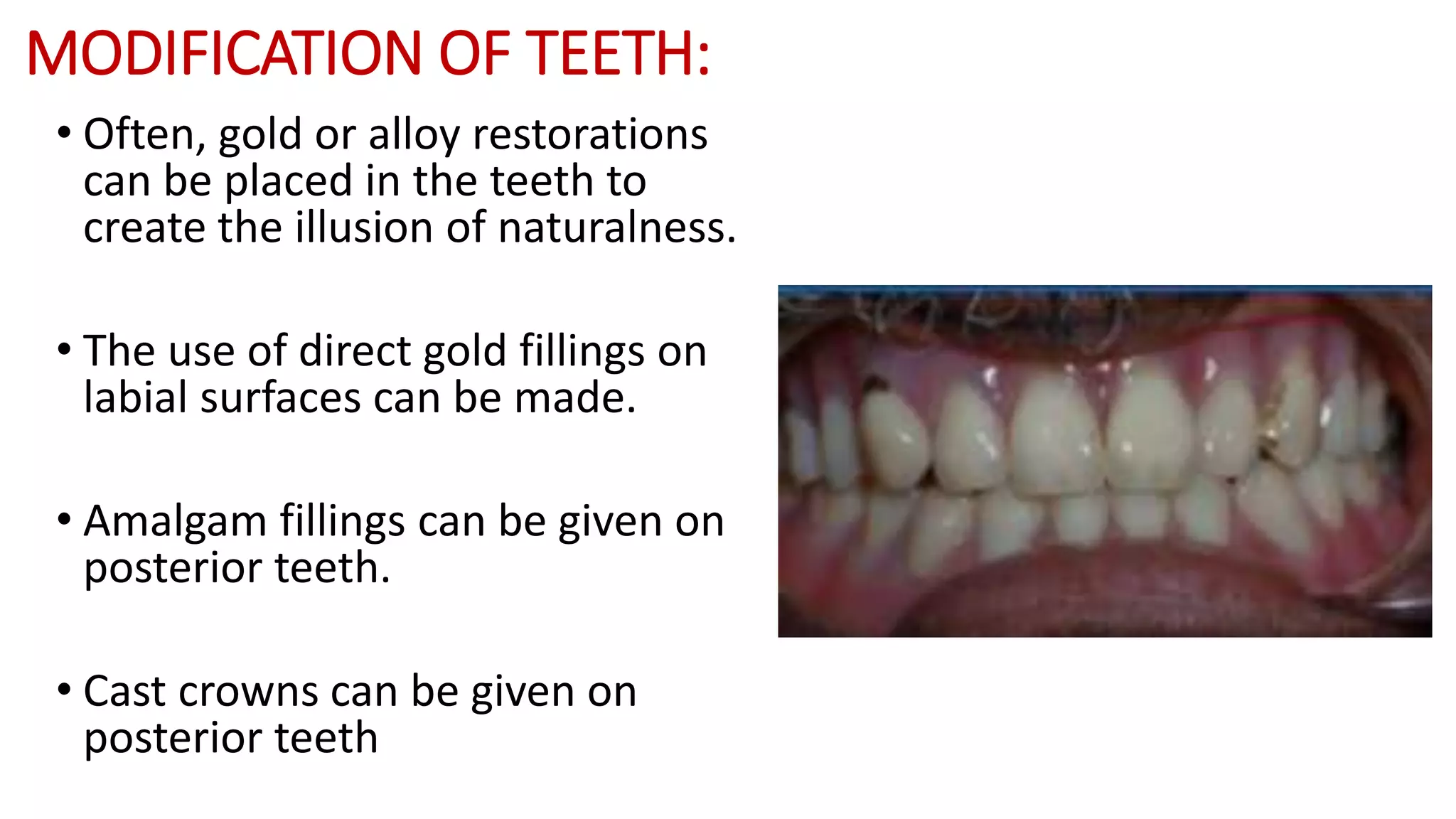 Characterization in complete dentures | PPTX