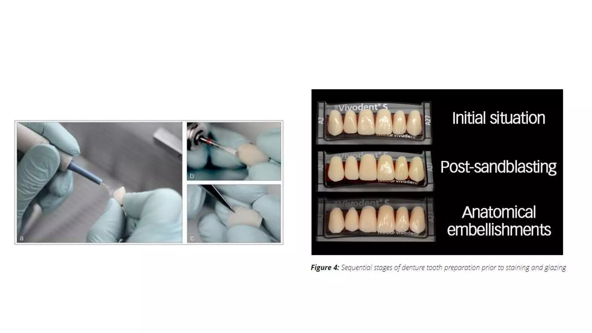 Characterization in complete dentures | PPTX