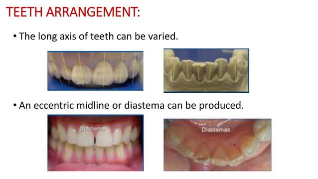Characterization in complete dentures | PPTX | Dental Health | Diseases ...