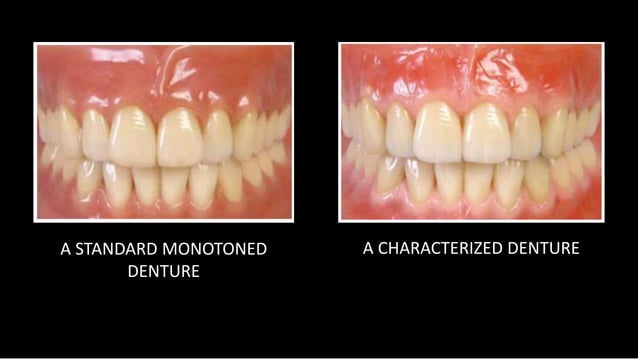 Characterization in complete dentures | PPTX | Dental Health | Diseases and Conditions