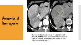 Characterisation of liver masses radiology | PPTX