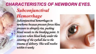 Subconjunctival Hemorrhage Newborn