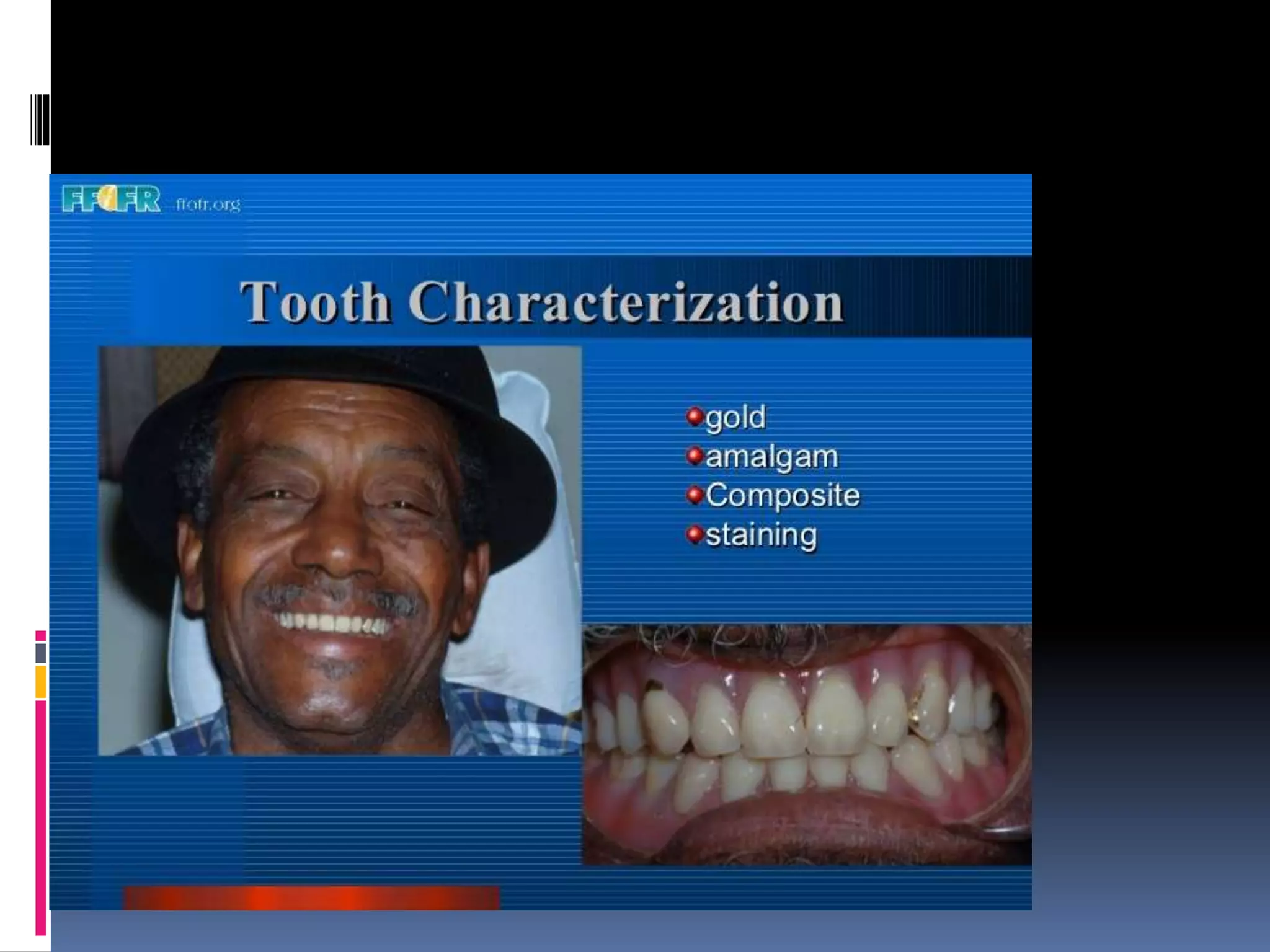 Characterization of complete denture | PPTX