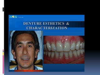 Characterization of complete denture | PPTX