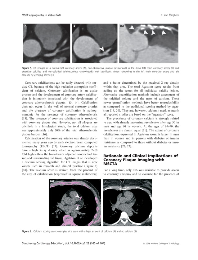 Characterizing stable coronary plaques with msct angiography | PDF