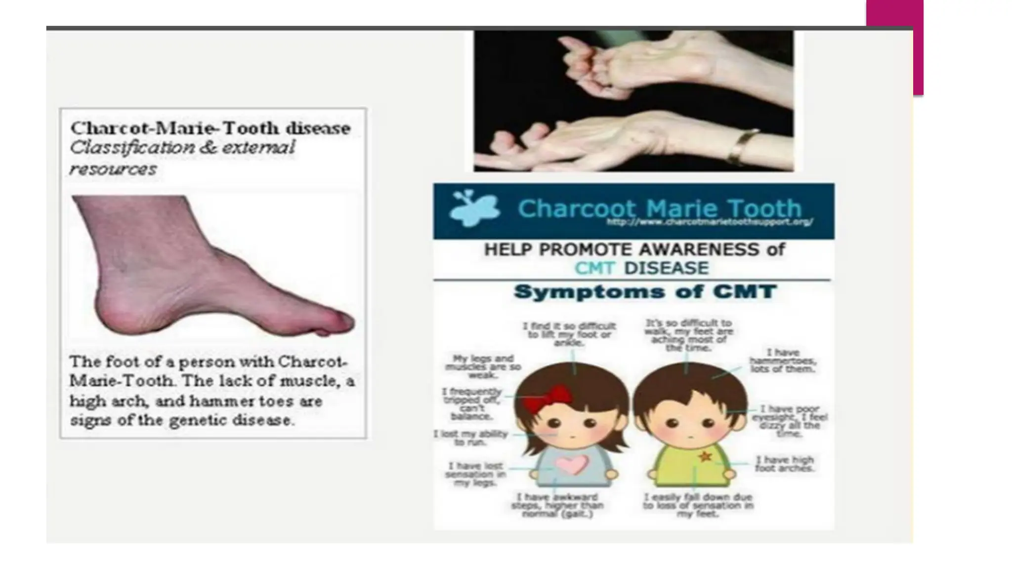 Charcot-Marie-Tooth-disease-new-1.pdf