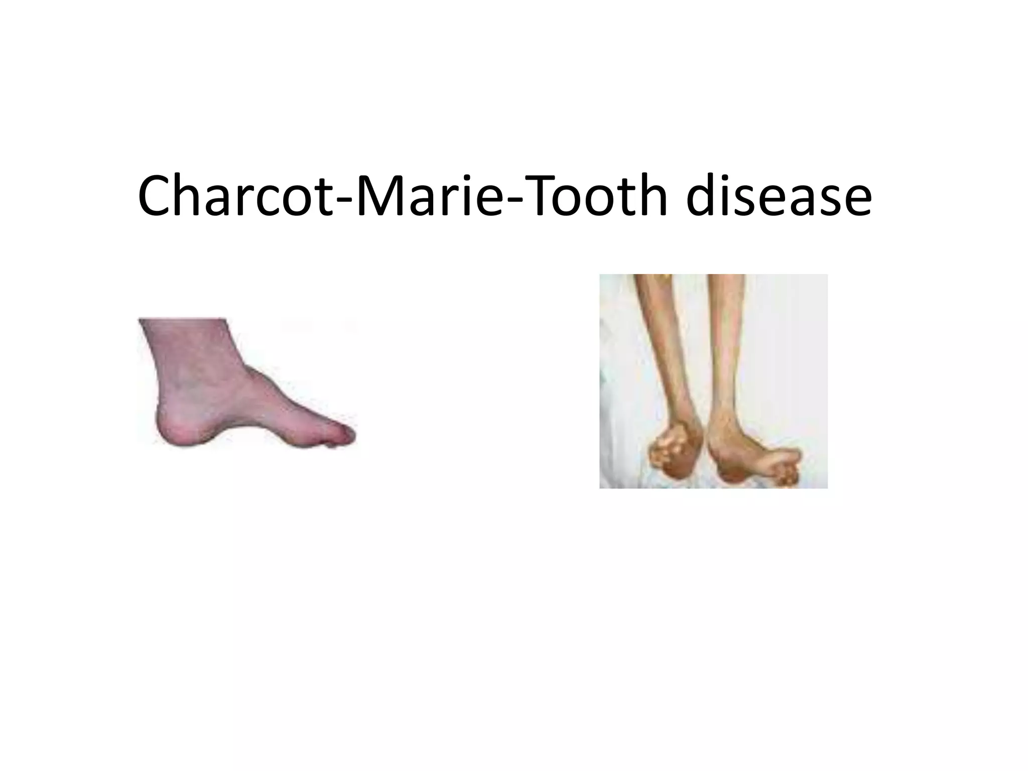 Charcot marie-tooth disease | PPTX