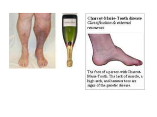 Charcot marie-tooth disease | PPT