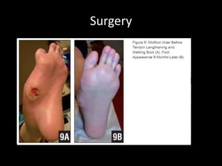 Charcot foot | PPTX