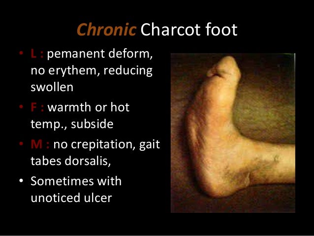 Charcot foot