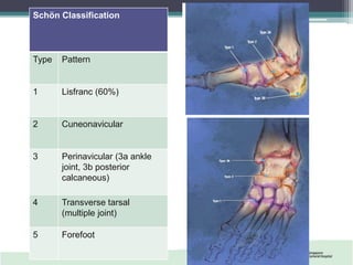 Charcot foot | PPT
