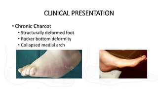 Charcot foot | PPTX