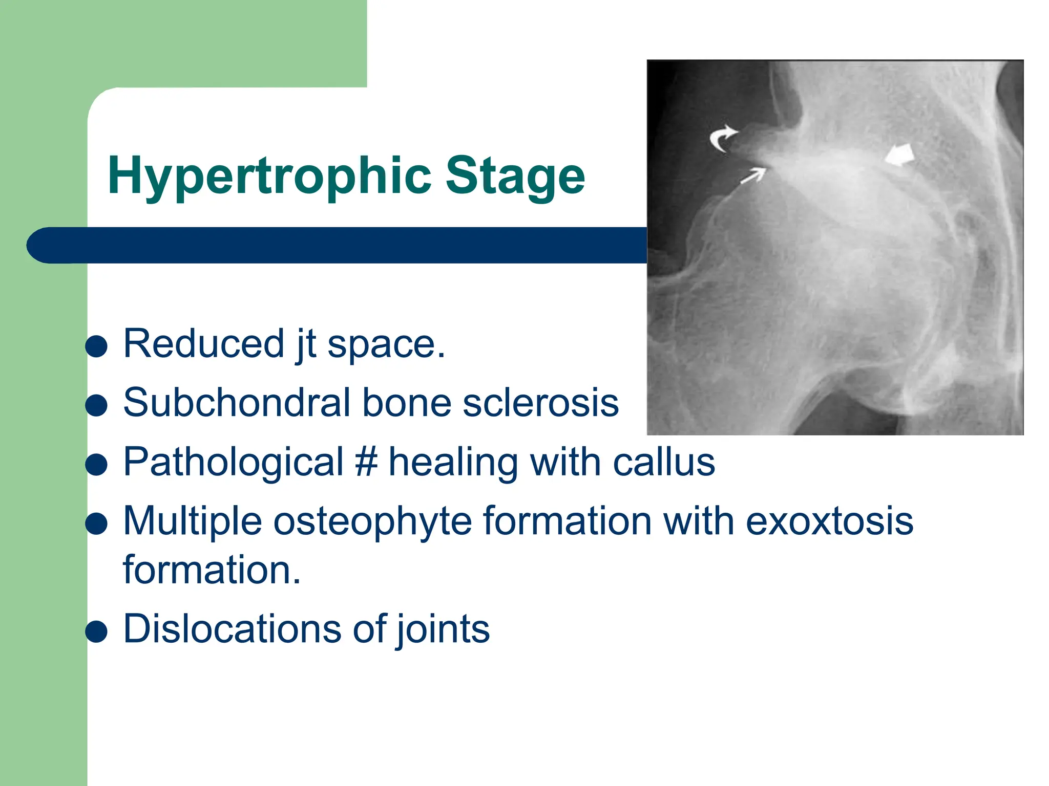charcot joint. Arthropathy. pptx | PPTX