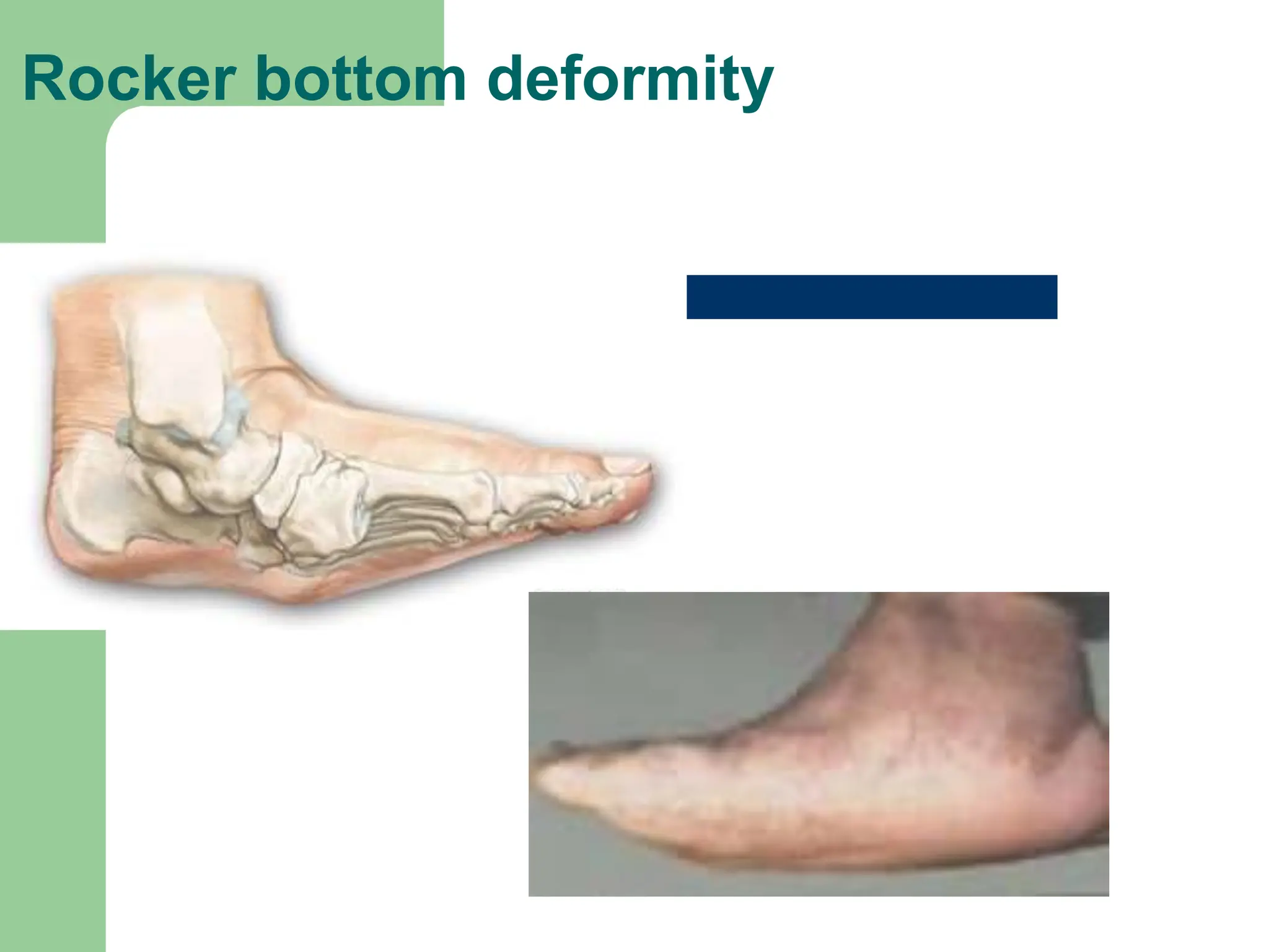 charcot joint. Arthropathy. pptx | PPTX