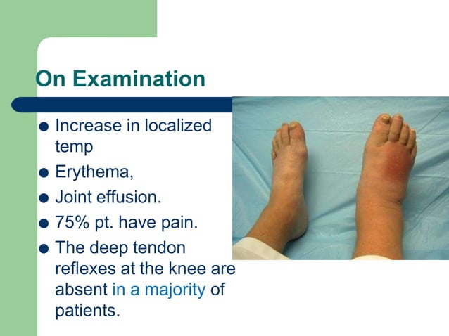 charcot joint. Arthropathy. pptx | PPTX