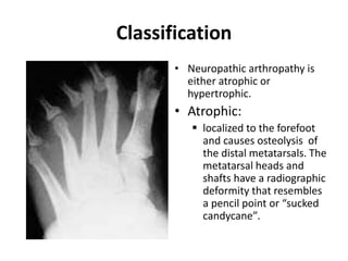 Charcot joint and methods of arthrodesis | PPTX