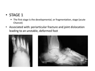 Charcot joint and methods of arthrodesis | PPTX