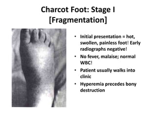 Charcot joint and methods of arthrodesis | PPTX