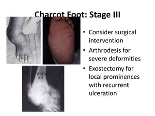 Charcot joint and methods of arthrodesis | PPTX