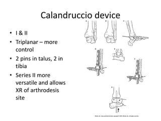 Charcot joint and methods of arthrodesis | PPTX