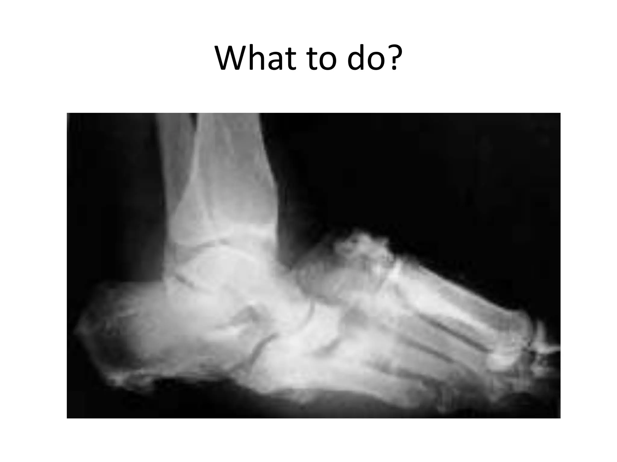 Charcot Joint & Methods of Arthrodesis.pptx