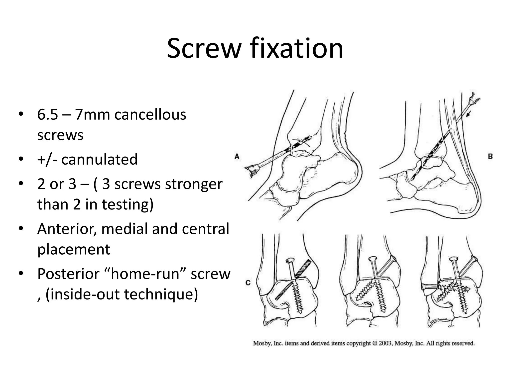 Charcot Joint & Methods of Arthrodesis.pptx
