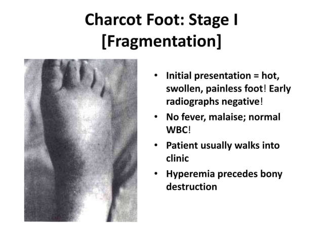 Charcot Joint & Methods of Arthrodesis.pptx