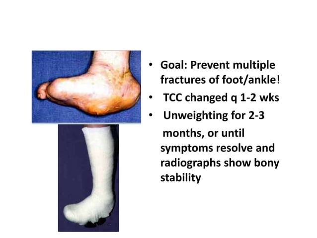 Charcot Joint & Methods of Arthrodesis.pptx