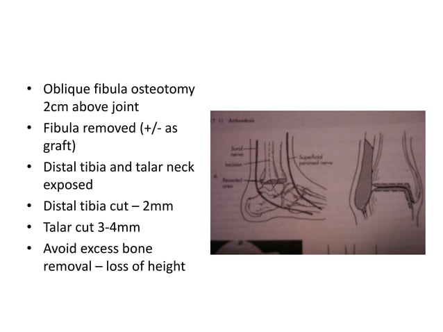 Charcot Joint & Methods of Arthrodesis.pptx