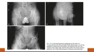 charcot marie tooth disease (CMT) pediatric.pptx