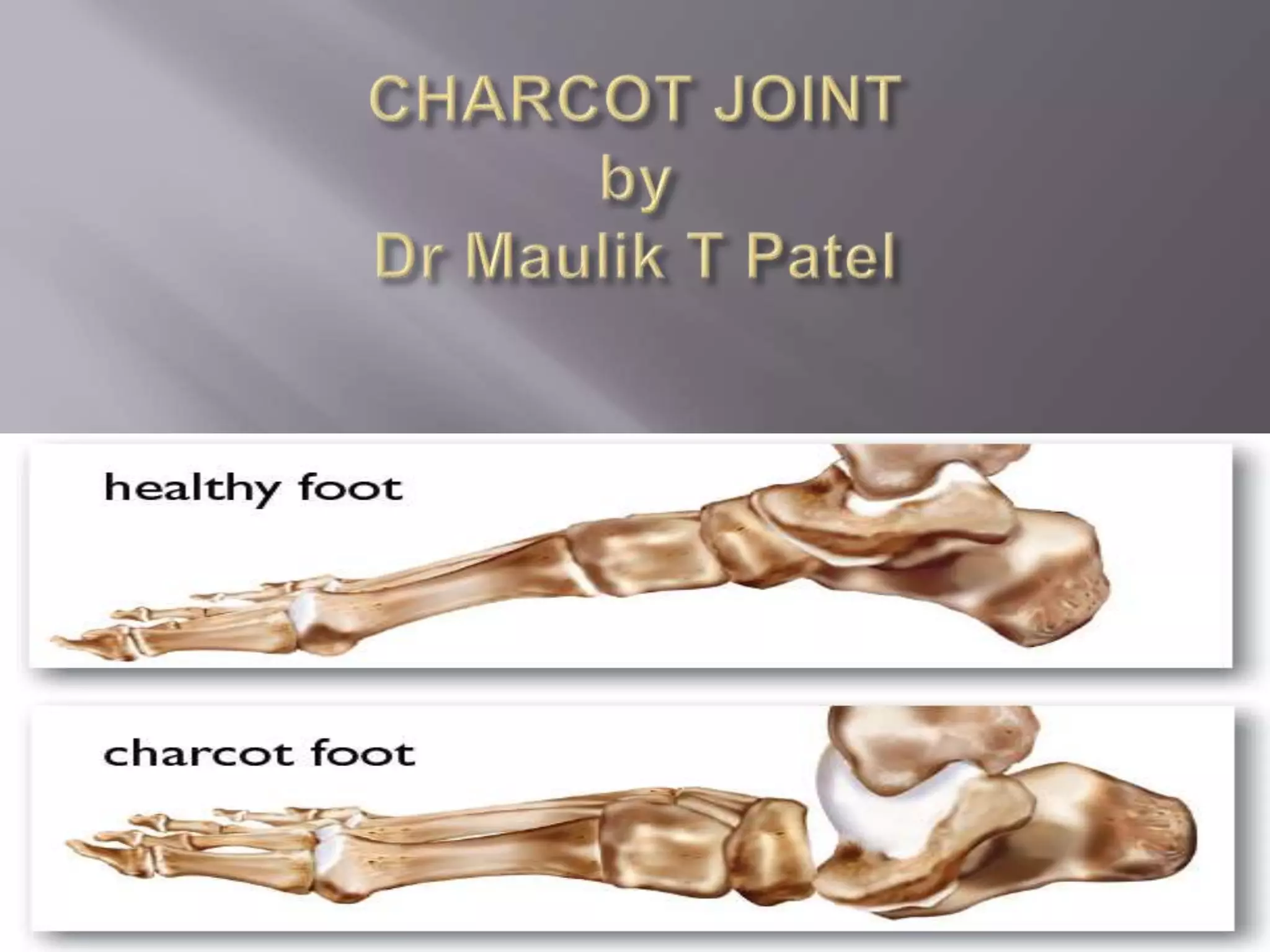 Charcot joint / Neuropathic Joint | PPTX