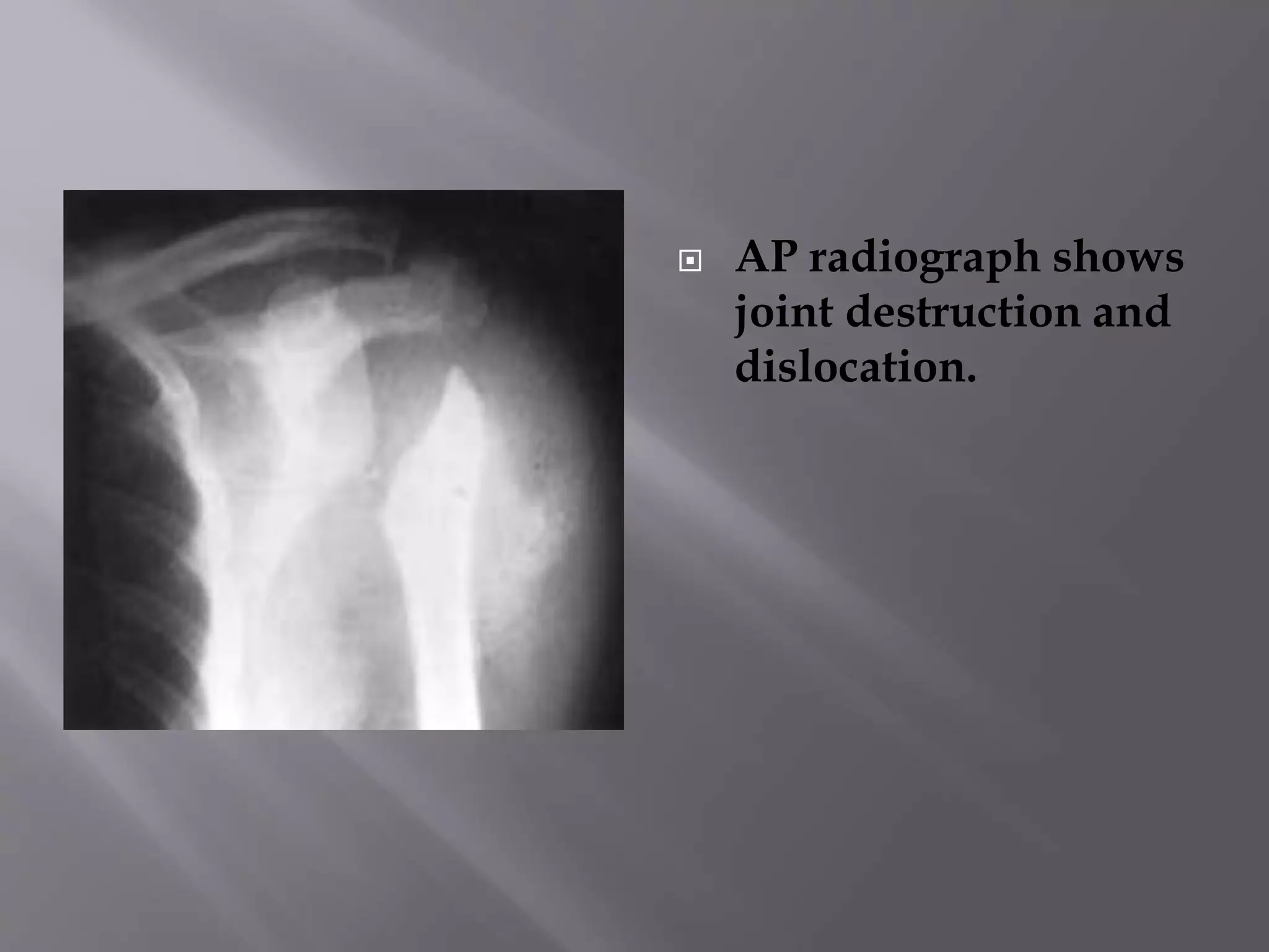 Charcot joint / Neuropathic Joint | PPTX