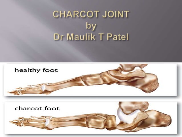 Charcot joint / Neuropathic Joint | PPTX