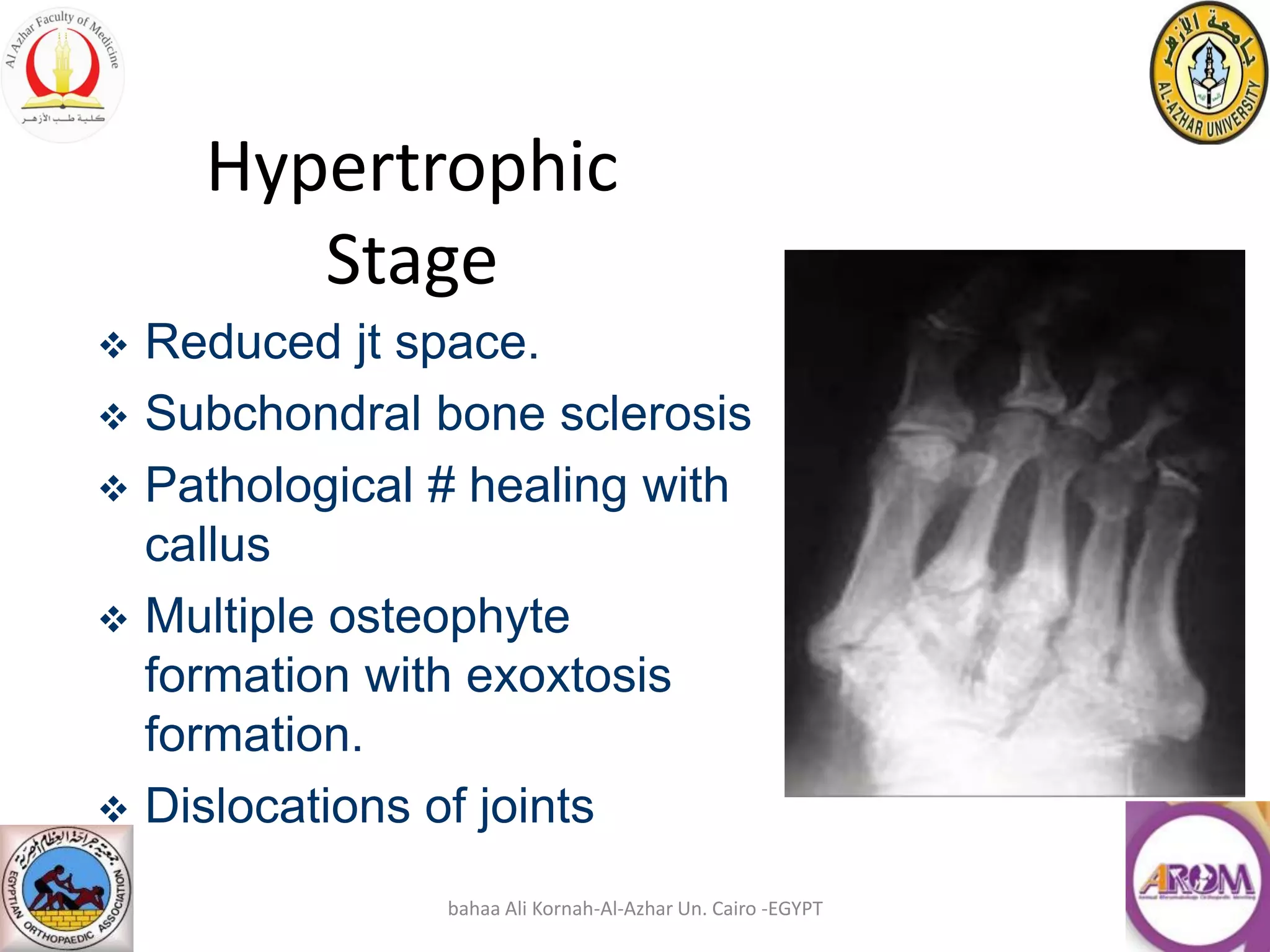 Charcot neuropathy. | PDF
