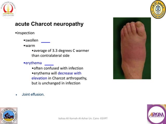 Charcot neuropathy. | PDF