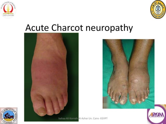 Charcot neuropathy. | PDF