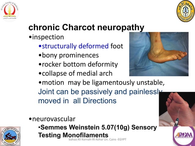 Charcot neuropathy. | PDF