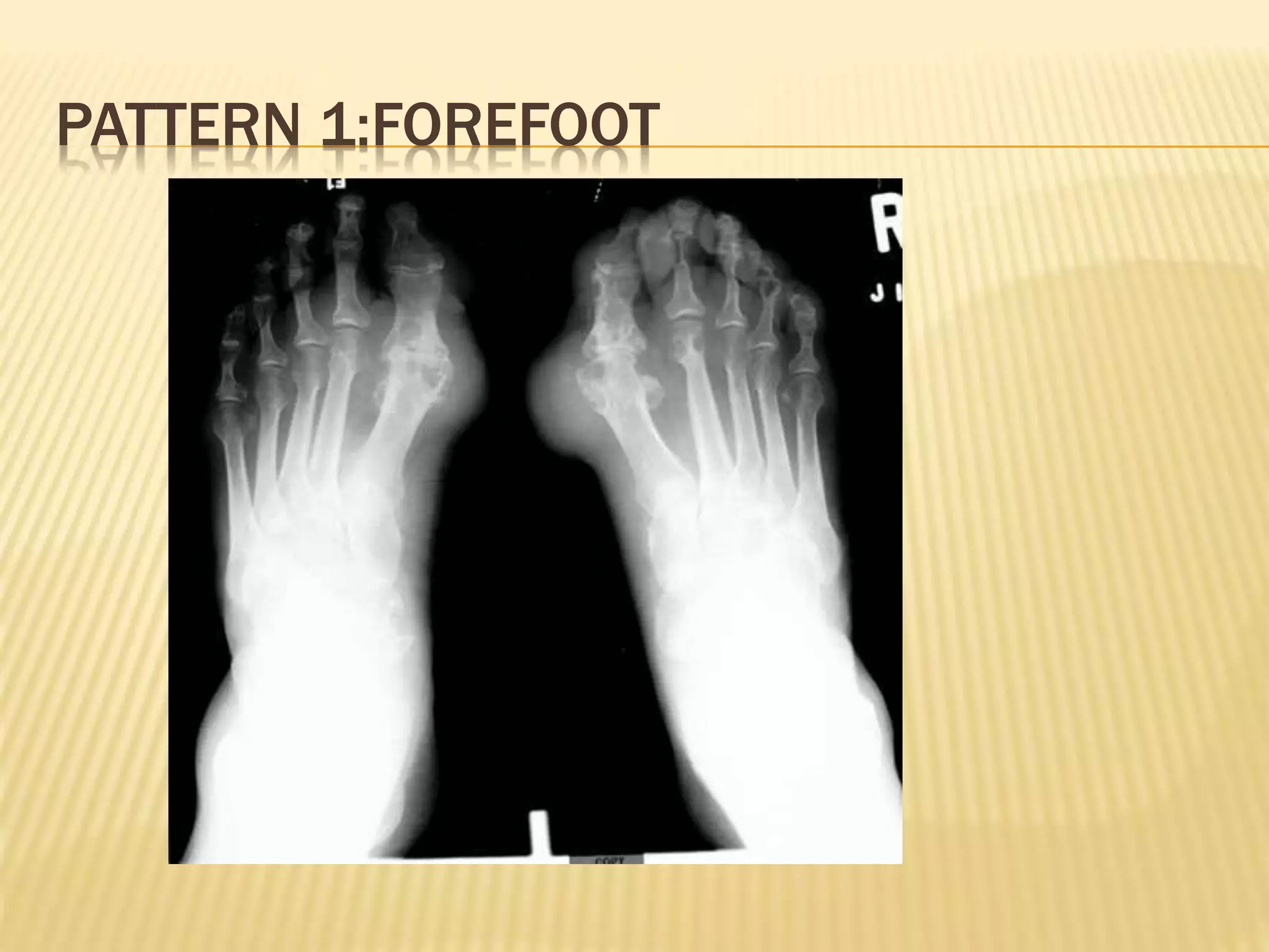 Charcot joint arthropathy and rehabilitation management | PPTX